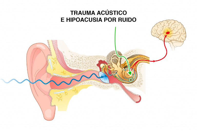 Enfermedades del Oído o Pérdida Auditiva – Oímos